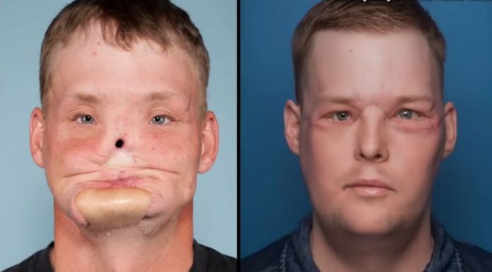 L’incroyable greffe du visage d’Andy Sandness (Vidéo)
